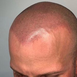 SMP Hairline Styles For Men | Scalp Provoco
