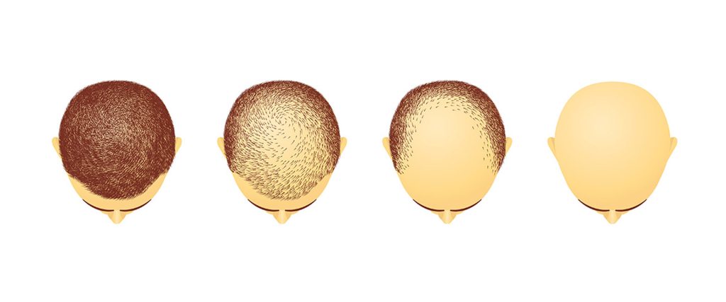 Male Pattern Baldness Treatment in London | Scalp Provoco