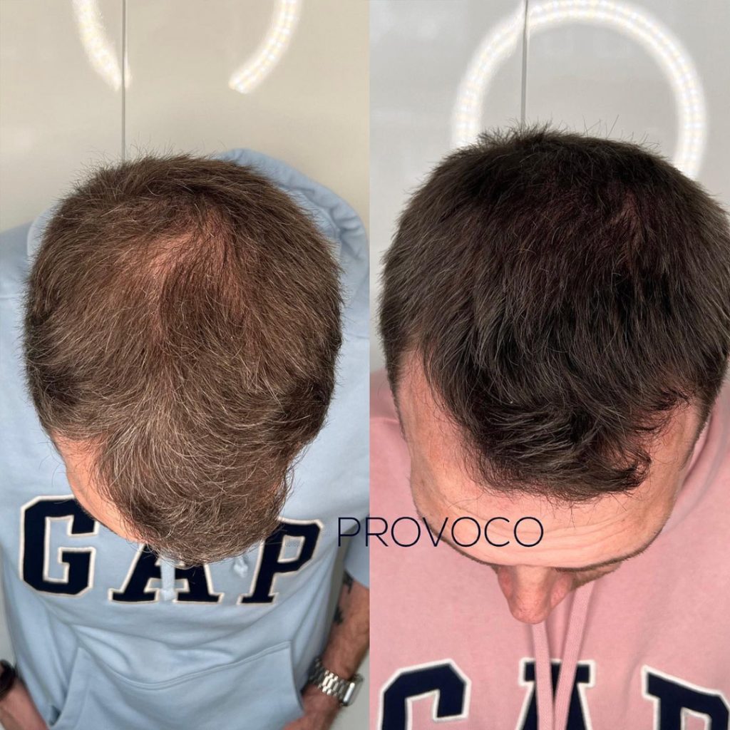 Hair density crown SMP | Scalp Provoco
